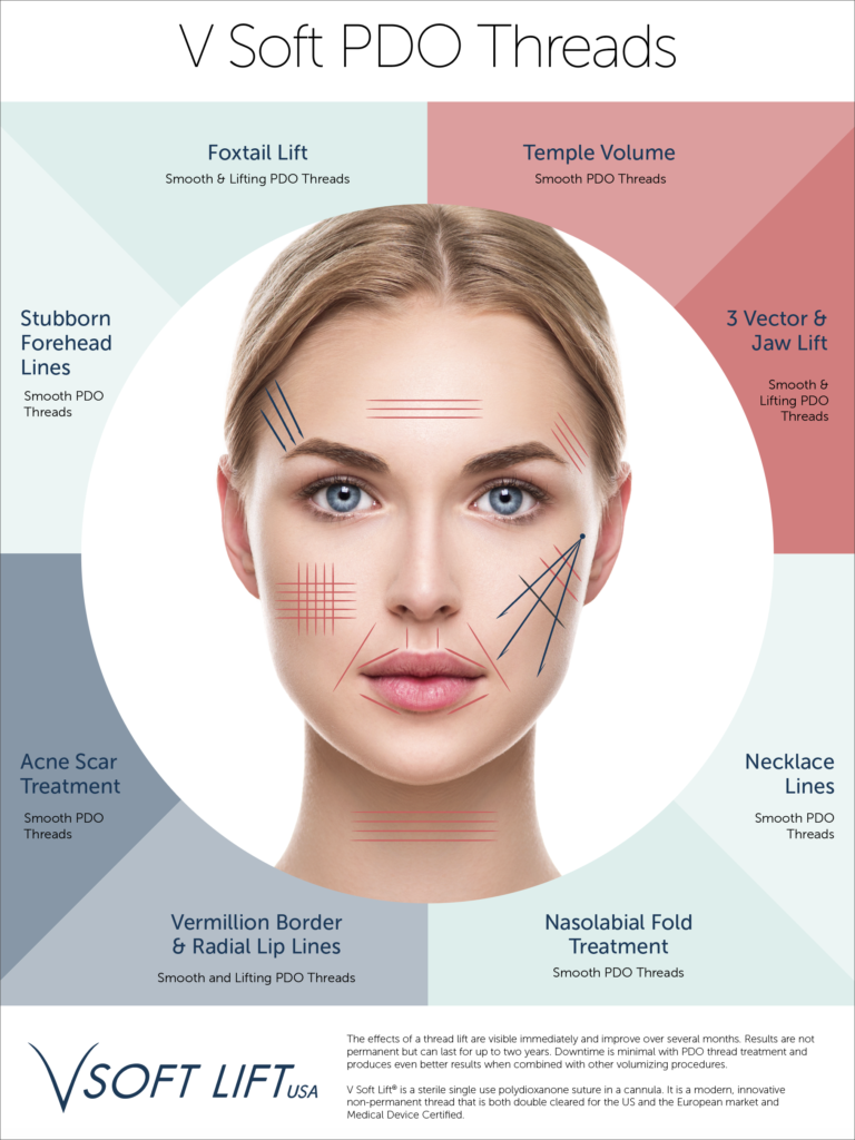 Wheel of Treatment PDO Thread Poster - V Soft Lift